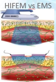 Flexus - Passive Gymnastics with high impact electromagnetic shock ...