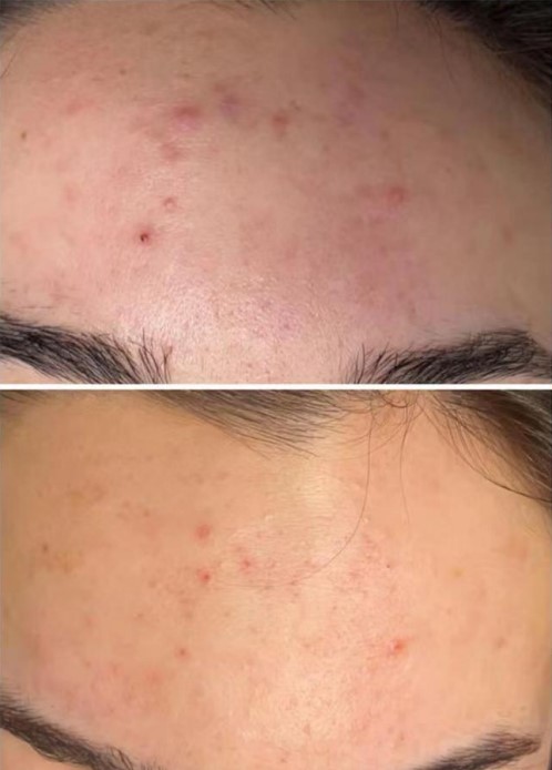 Plataforma de Plasma (Tecnologia de Plasma Frio y Plasma Fraccionado ...