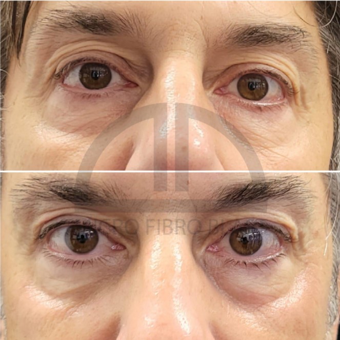 Plasma Platform (Cold Plasma and Fractionated Plasma Technology ...