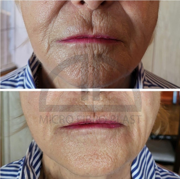 Plasma Platform (Cold Plasma and Fractionated Plasma Technology ...