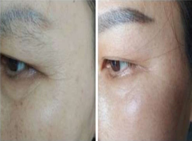 Plataforma de Plasma (Tecnologia de Plasma Frio y Plasma Fraccionado ...