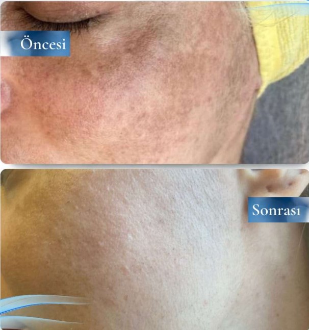 Plataforma de Plasma (Tecnologia de Plasma Frio y Plasma Fraccionado ...