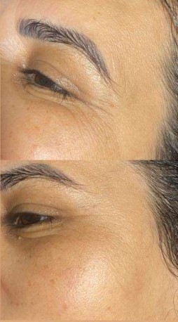 Plataforma de Plasma (Tecnologia de Plasma Frio y Plasma Fraccionado ...